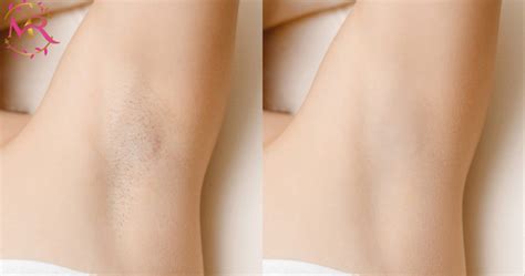 Laser Hair Removal Dubai Uae Medrose Medical Center Barsha Heights