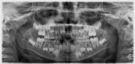Ectopic Eruption Object Detection Dataset By Yildiz Teknik