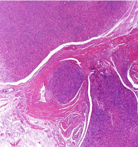 Figure 2 From Benign Metastasizing Leiomyoma Of The Lung Case Report