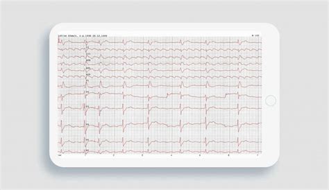 Computer Vision System For Ecg Computer Vision In Medical Imaging