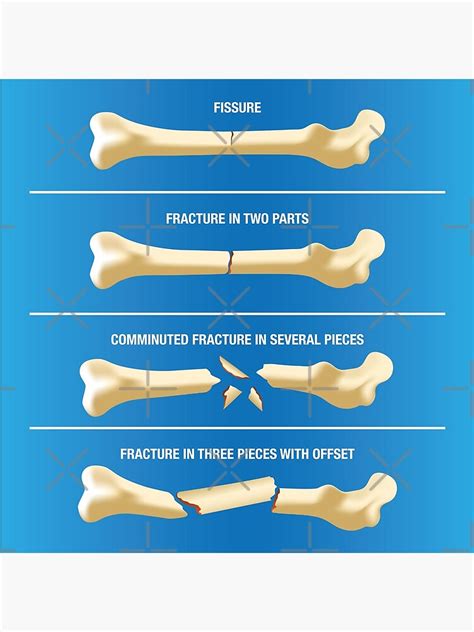 Anatomy Various Skeletal Bone Fractures Ideal For Med