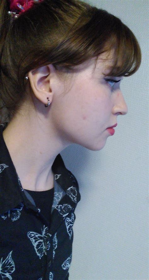 Djs 10 Days Post Op Got The Splint Removed Yesterday 🥳 R Jawsurgery