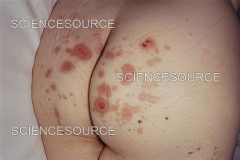 Photograph Pyoderma Gangrenosum Science Source Images