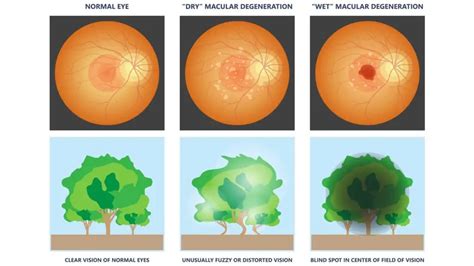 Dry Amd Decoded Your Guide To Clearer Vision