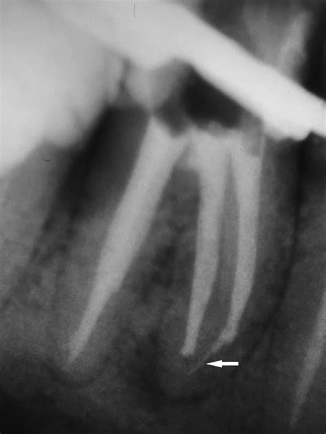 Removal Of Root Canal Filling Materials Pocket Dentistry
