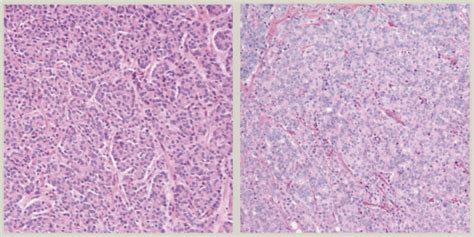 Cribriform Prostate Cancer An Aggressive Pattern Where Definition And