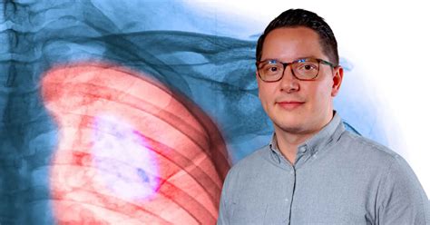 5 Mitos Y Verdades Sobre El Cáncer De Pulmón