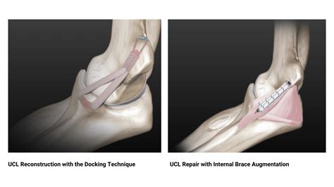Elbow Ucl Repair With Internal Brace Protocol At Tamara Wilson Blog