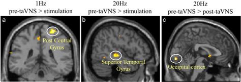 Evaluation Of The Modulation Effects Evoked By Different Transcutaneous