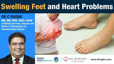 Swollen Feet Is It Due To Heart Problem Dr C Raghu Interventional Cardiologist Youtube