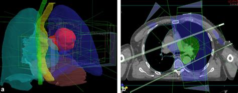 3d Conformal Rt 3d Crt For A Left Upper Lobe Nsclc A 3d Image