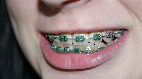 Braces Rubber Bands Purpose Effects Downsides Results