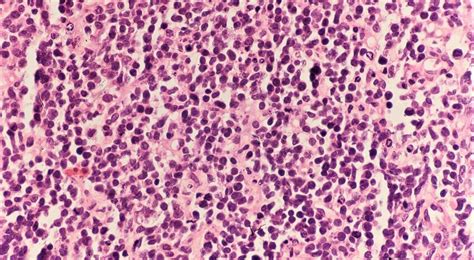H And E Section Of Biopsy From Maxillary Mass Showing Tumor Tissue
