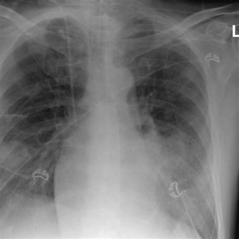 Ct Scan Of The Chest Showing Bilateral Pleural Effusions And