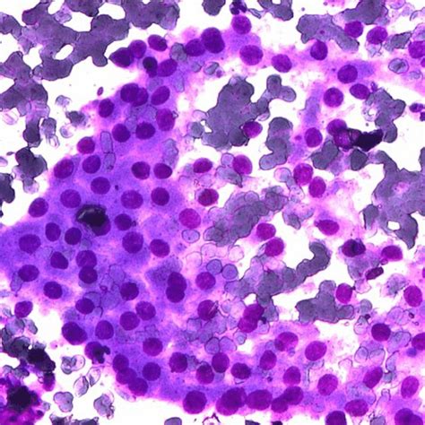 Focal Chronic Thyroiditis Patchy Lymphocytic Inflammation With Small