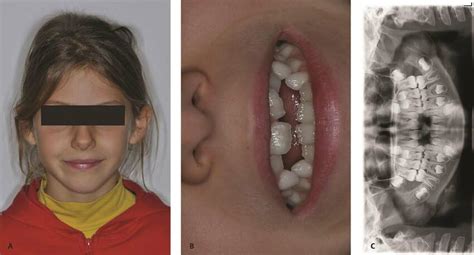 The Second Patient A 7 Year Old Female Hyperdivergent Female