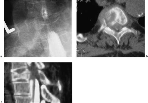 Intraspinal Masses Radiology Key