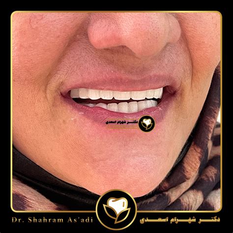 روکش زیرکونیا زیرکونیا چیست فرق لمینت و روکش زیرکونیا دکتر شهرام