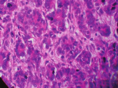 Photomicrograph Of Granulosa Cell Tumor With Callexner Bodies