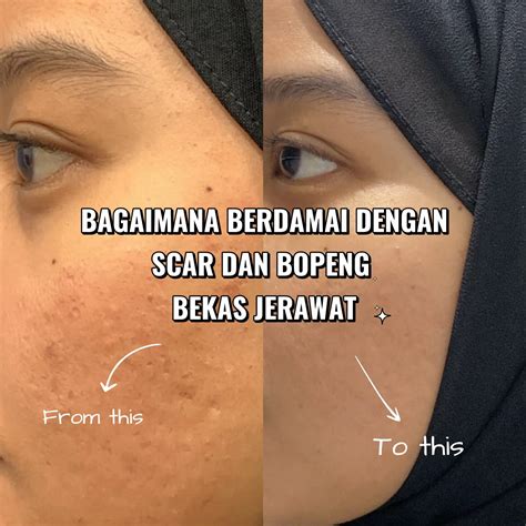 Say Goodbye To Scarbopeng Bekas Jerawat ‼️ Galeri Diposting Oleh