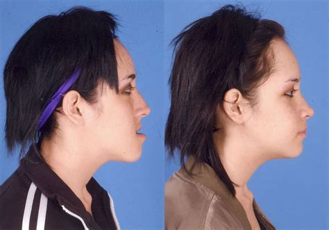 Before And After Jaw Surgery Results James P Bradley Md