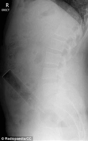 X Ray Anal Telegraph