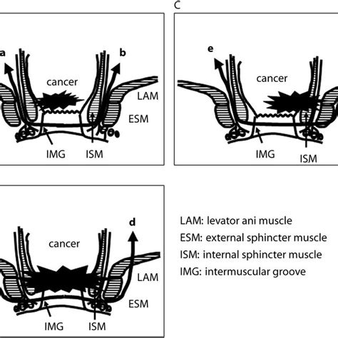 A Schematic Drawing Of The Resection Line A The Resection Line A B