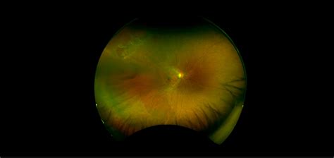 California Peripheral Retinal Tear Rg