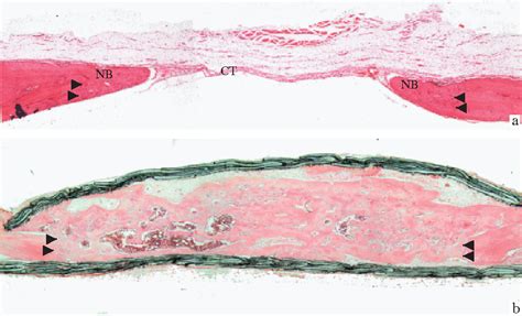 Lobsteins Disease Semantic Scholar