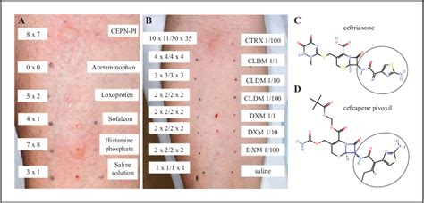 Figure 1 From Cross Reactivity Of Cephalosporins Allergic Immediate