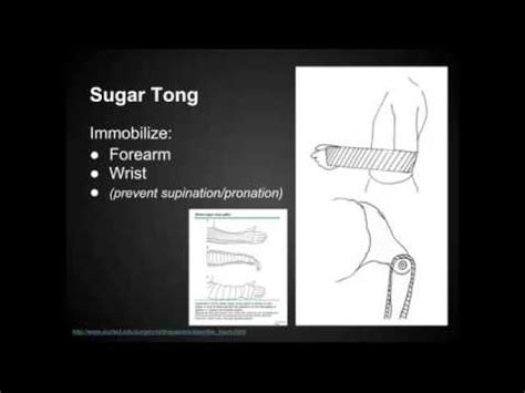 Sugar Tong Splint Cpt Code 07 2021
