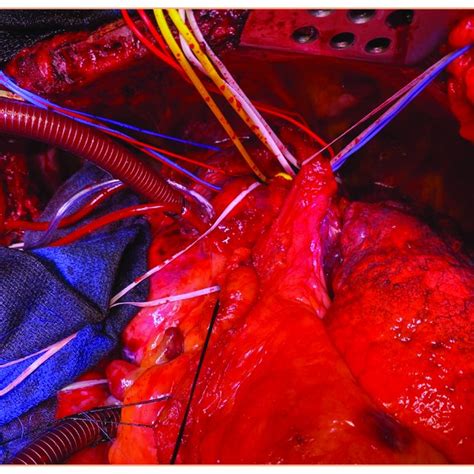 Surgical Exposure Of The Complete Aortic Arch Via A Bilateral Clamshell
