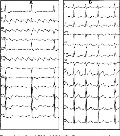 Figure 1 From Biatrial Activation In Isthmus Dependent Atrial Flutter Semantic Scholar