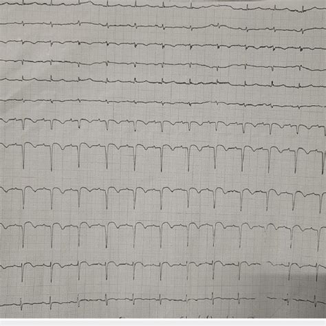 Electrocardiogram Showing St Segment Elevation From V1 To V5 And T Wave Download Scientific