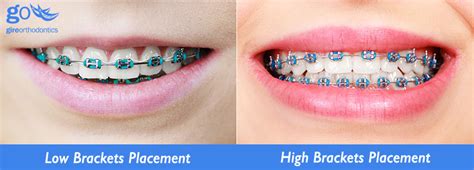 How Do Braces Brackets Break What To Do With A Broken Bracket On