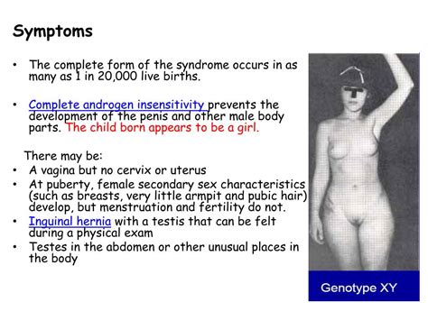 Ppt Disorders Of Gonadal Development Powerpoint Presentation Free