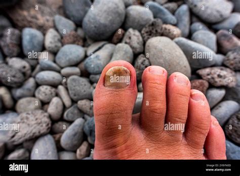 Right Big Toe Nail Blackened By A Crush And By The Tight Shoes Of A