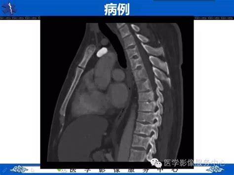 【影像征象】鱼口征——镰状细胞病 影像ppt