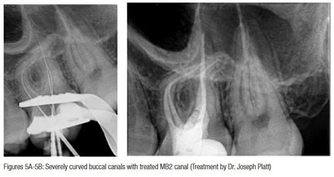 Endodontic News Frequency Of Location Of A Second Mesiobuccal Canal In Maxillary First And