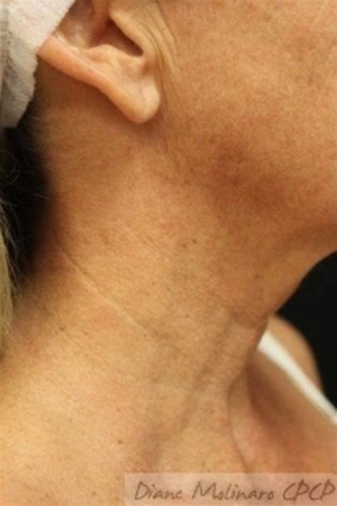 Micro Needling And Collagen Induction Therapy CIT