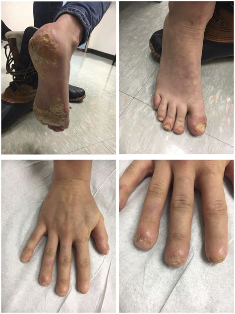 Palmoplantar Keratoderma With Deafness Phenotypic Variability In A