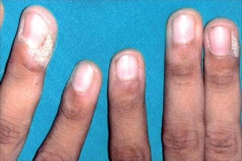 Gambar Kutil Alodokter