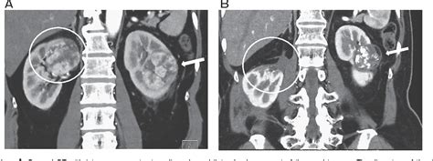 Figure 1 From A Combination Therapy Of Partial Nephrectomy And