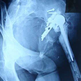 Clinical Photograph 6 Months After The Posterior Column Plating Download Scientific Diagram