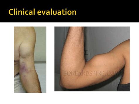 Distal Biceps Tendon Rupture By Hussain Algawahmed Ppt