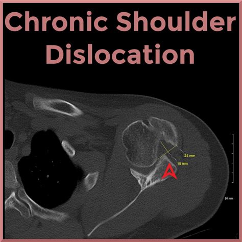 A Case Of Chronic Shoulder Dislocation Sports Medicine Review