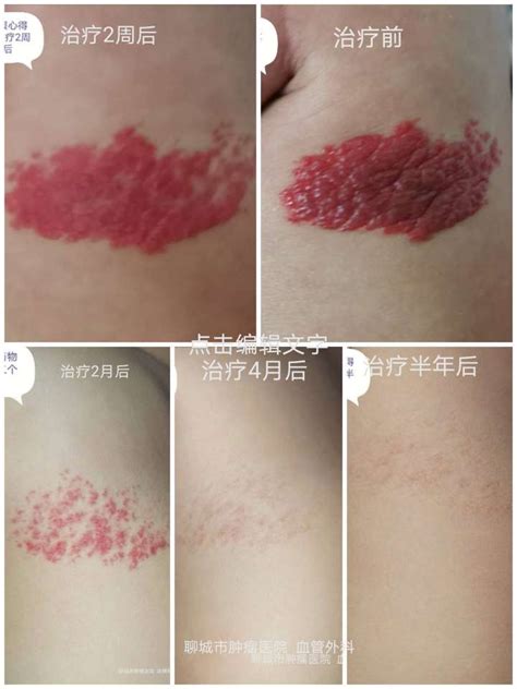 血管瘤药物治疗分享 京东健康