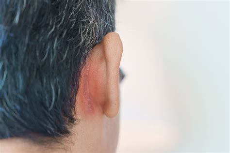 460 Dermatitis Seboroik Foto Stok Potret And Gambar Bebas Royalti Istock