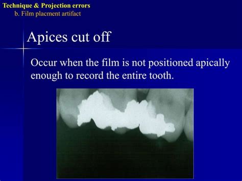 Radiographic Errors And Artifacts Pptx Photo Editing Software Computer Software And