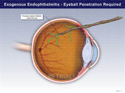 Exogenous Endophthalmitis Eyeball Penetration Required Trial